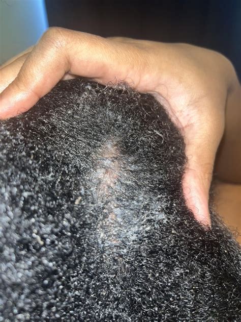 Keratosis Warty Growth Update Rwarts
