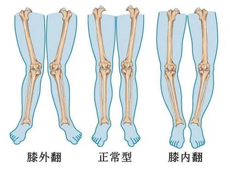 青少年与你，不可忽视的xo型腿 知乎