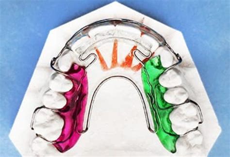 Zocchelab Spring Aligner