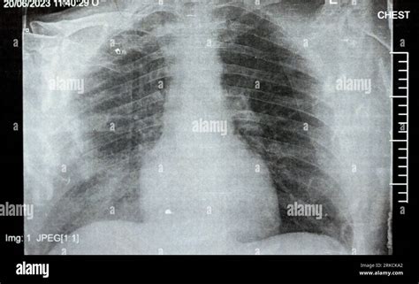 Plain X Ray Chest Showing Infectious Pulmonary Process Pneumonia With