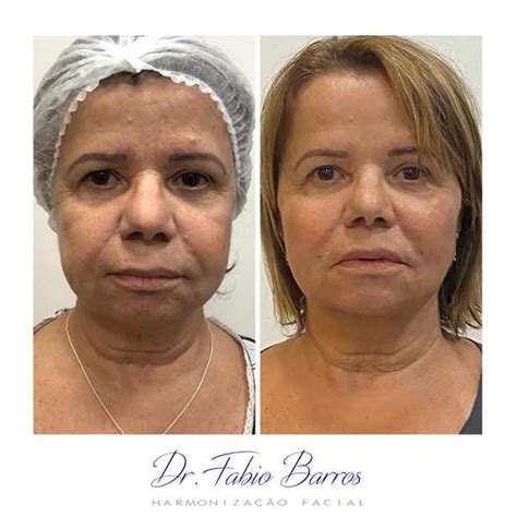 Harmonização Facial Com O Dr Fabio Barros