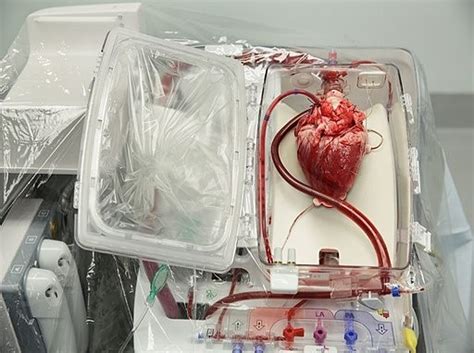 How Much Does A Heart Cost Exploring The Worth Procedure And Success