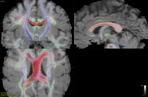 Issues With Tractography On Simulated Dwi Data Mrtrix3 Community