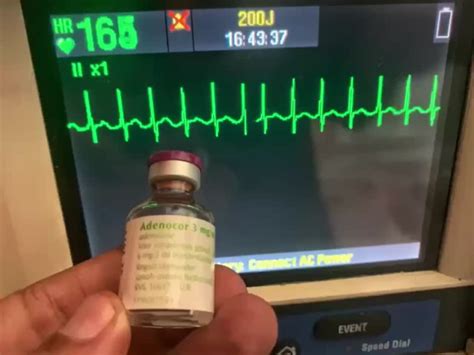 Dr Touseef A On Linkedin Reversion Of Svt ē Adenosine Supraventricular Tachycardia Svt Is A…