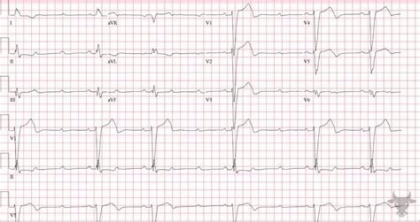 Second Degree Atrioventricular Block Mobitz Ii Ecg Stampede