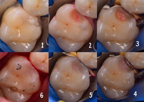 Ammar Kattan On Linkedin Biomimeticdentistry Dentistry Dentist Oman