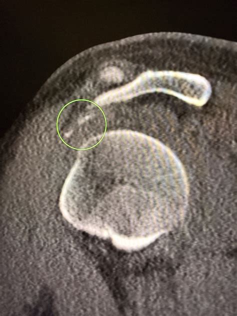 The Resorptive Phase Of Calcific Tendinosis Is Characterized By The