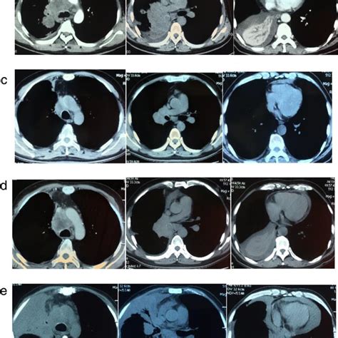 Computed Tomography Ct Evolution Of The Target Lesion And Non‐target Download Scientific