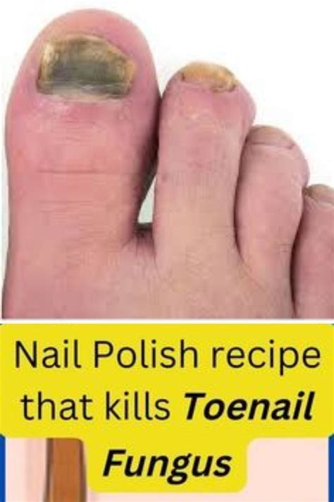 Homemade Polish Kill Toenail Fungus Artofit