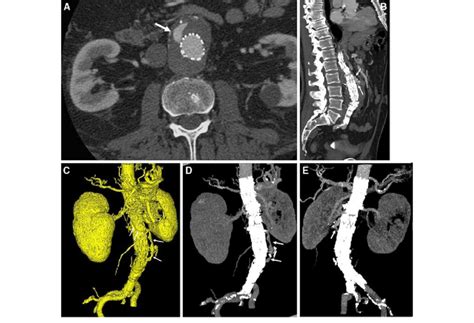 Type I Endoleak In Patient 2 Visualized By Axial Ct Images A And