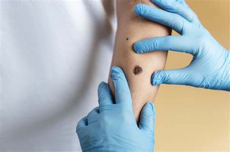 Mappatura Nei Catania Visita Dermatologica Aranzulla D