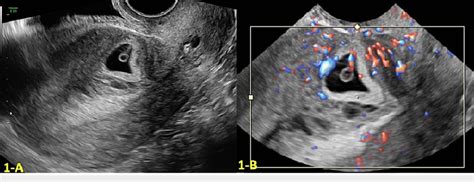 6 Week Transvaginal Ultrasound