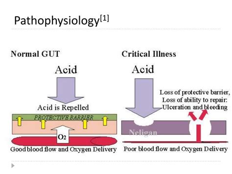 Ppt Gi Prophylaxis Powerpoint Presentation Free Download Id6878649
