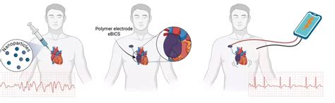 Injectable Pacemaker Regulates Heartbeat For 5 Days Then Dissolves