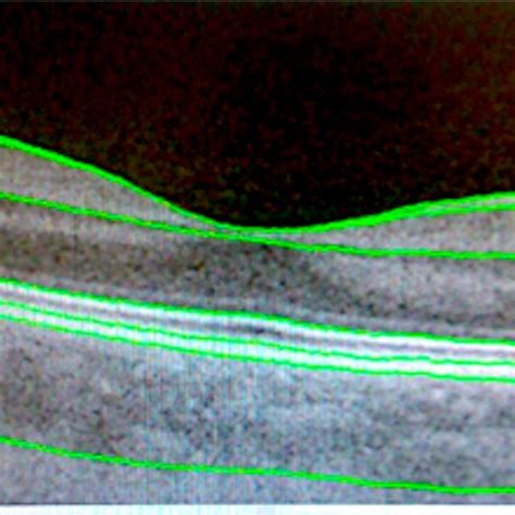 segmentation of the different retinal layers as well as the choroid