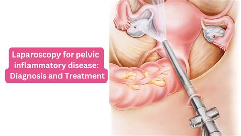 Pelvic Inflammatory Disease Treatment Naturally