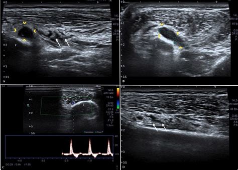 Ultrasound Scans Of Tibio Fibular Proximal Recess And Fibular Nerve