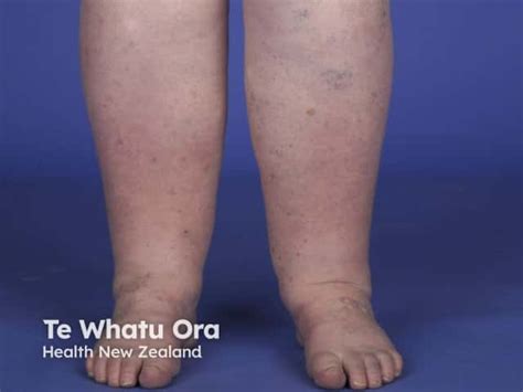 Pretibial Myxoedema Images — Dermnet