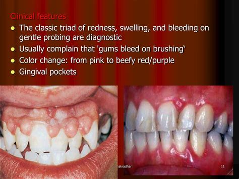 Ppt Gingivitis Inflammation Of Gingival Tissues Commonly Associated With Dental Plaque