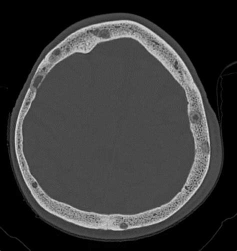 Osteolytic Lesions In The Skull Of A Patient With Multiple Myeloma R