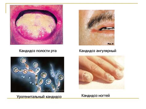 Патогенные грибы и вызываемые ими заболевания презентация онлайн
