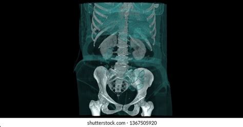 Computed Tomography Human Chest Abdomen D Stock Illustration