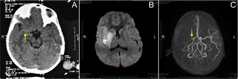A Head Ct Scan Non Contrast Showed Hyperdensity Yellow Arrow Of