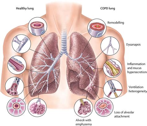 Chronic Obstructive Pulmonary Disease Lungs