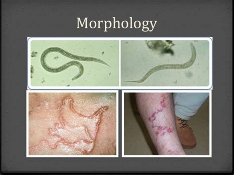 Hookworm Larva Migrans Presentation