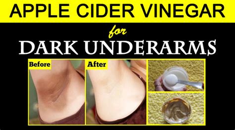Apple Cider Vinegar for Dark Underarms - Getinfopedia.com