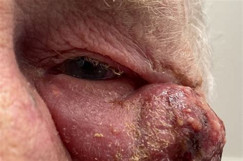 Rare Report Of Orbital Pyoderma Gangrenosum
