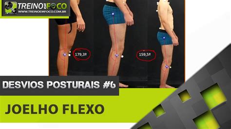 Joelho Flexo Desvios Posturais 6 Youtube