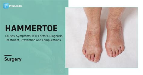 Hammertoe Causes Symptoms Risk Factors Diagnosis And Treatment