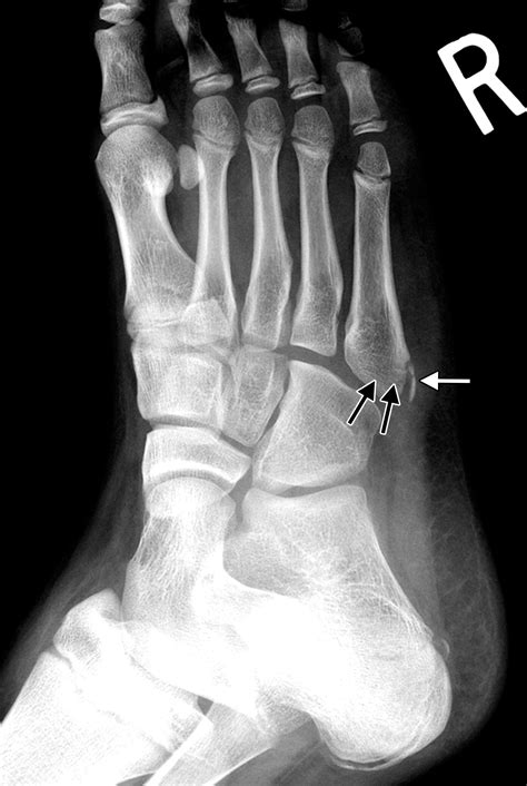 Figure 13 From Fracture Dislocations Of The Femoral H