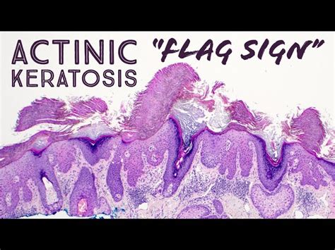 Actinic Keratosis Lip Histology Usmle Reddit Infoupdate Org