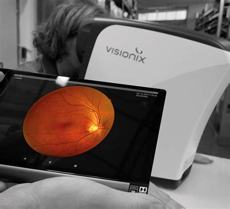 Visionix AI Retina Screening