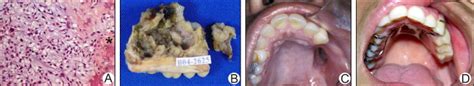 Maxillary Osteosarcoma In A Young Patient Undergoing Postorthodontic Treatment Follow Up The