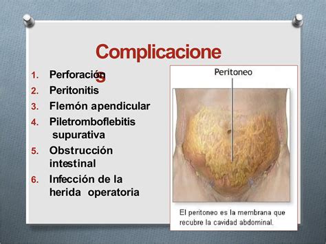 Apendicitis Aguda Y Sus Fases En La Enfermedad Del Paciente Pptx