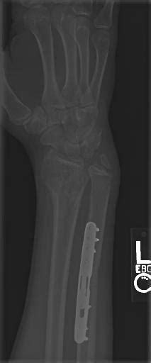 Bone Fracture Yolov8 Object Detection Dataset By NeuralNetwork