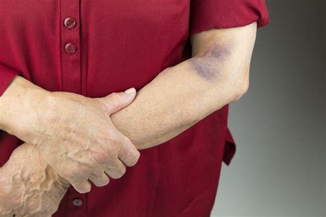 Do You Bruise Easily Texas Spine And Sports Therapy Center