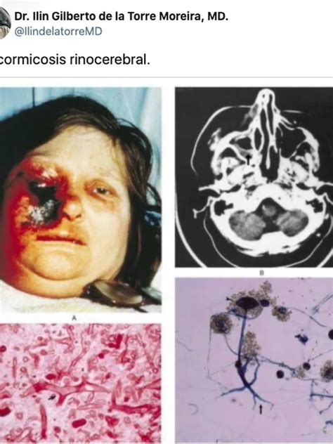 Encontraron El Patógeno Causante Del Hongo Negro Mucormicosis En Aire De La Cdmx Infobae