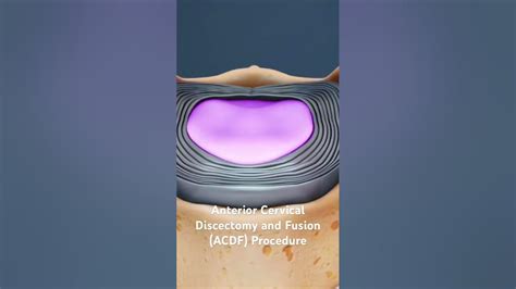 Anterior Cervical Discectomy And Fusion Acdf Procedure Youtube