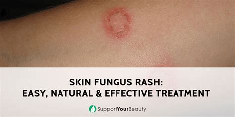 Fungal Skin Rash Treatment