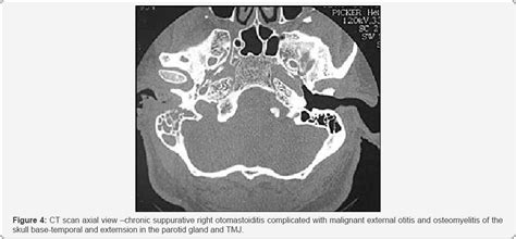 Necrotizing Otitis Externa Epos™