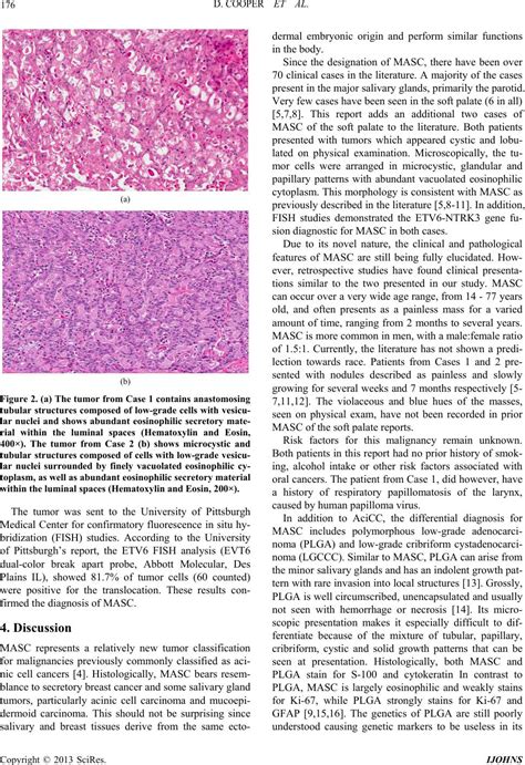 Mammary Analogue Secretory Carcinoma Of The Soft Palate A Report Of