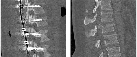 Understanding Flexion Distraction Fractures