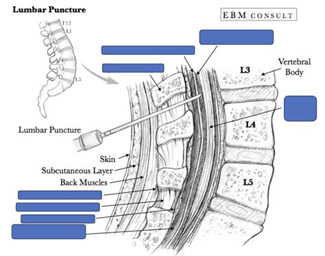 Lumbar Puncture Diagram Quizlet