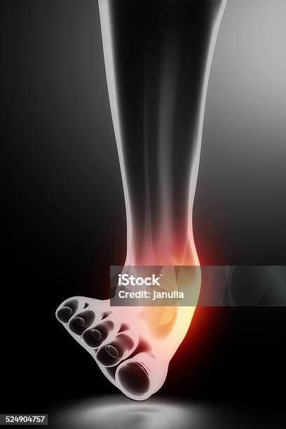 접질림 발목 블랙 X선 건강 진단에 대한 스톡 사진 및 기타 이미지 건강 진단 건강관리와 의술 검은색 Istock