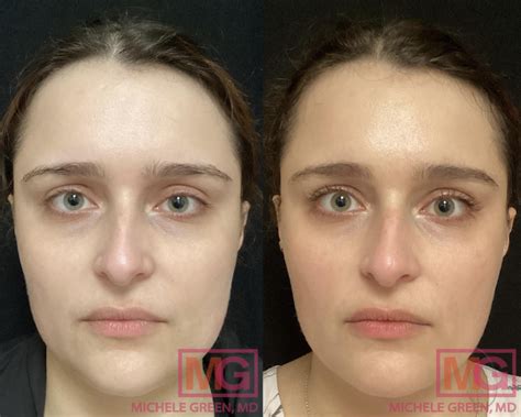 Botox Eyes Before And After