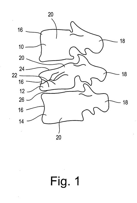 Vertebra Compression Fracture Patented Technology Retrieval Search